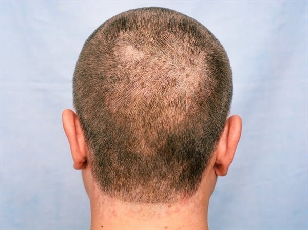Overview of Diagnosis and Management of Seborrheic Dermatitis ...